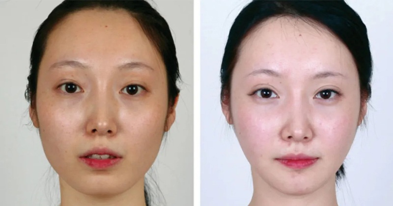 V-Line Surgery – Everything You Need to Know – Hillary Styled